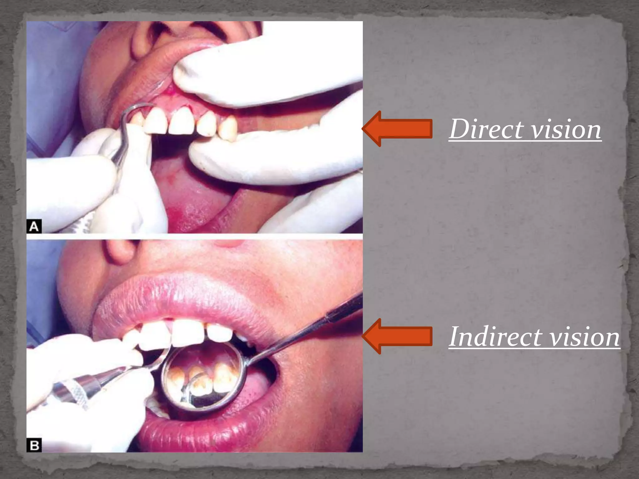 Principles of periodontal instrumentation [autosaved] | PPTX