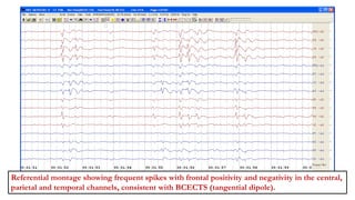 Principles of polarity in eeg | PPT