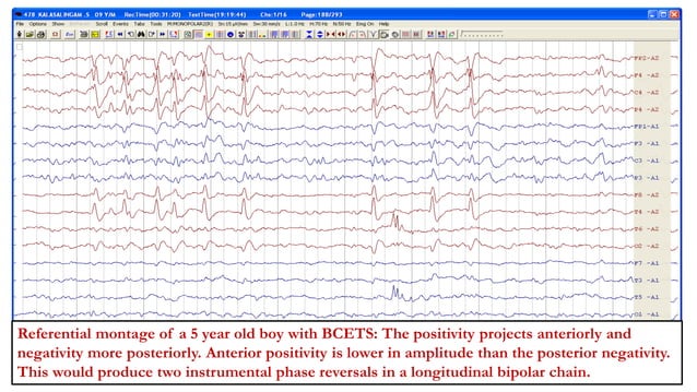 Principles of polarity in eeg