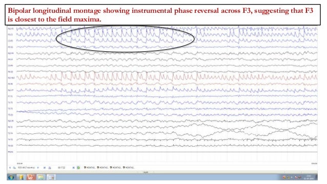 Principles of polarity in eeg