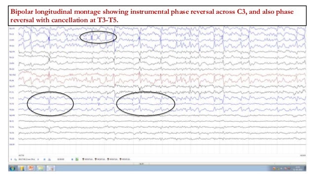 Principles of polarity in eeg