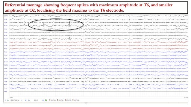 Principles of polarity in eeg