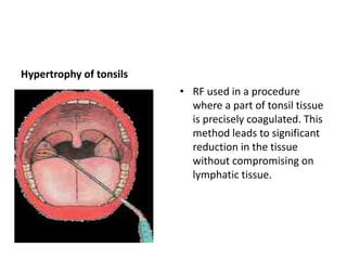 Principles Of Radiofrequency And Its ENT Applications | PPTX