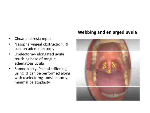 Principles Of Radiofrequency And Its ENT Applications