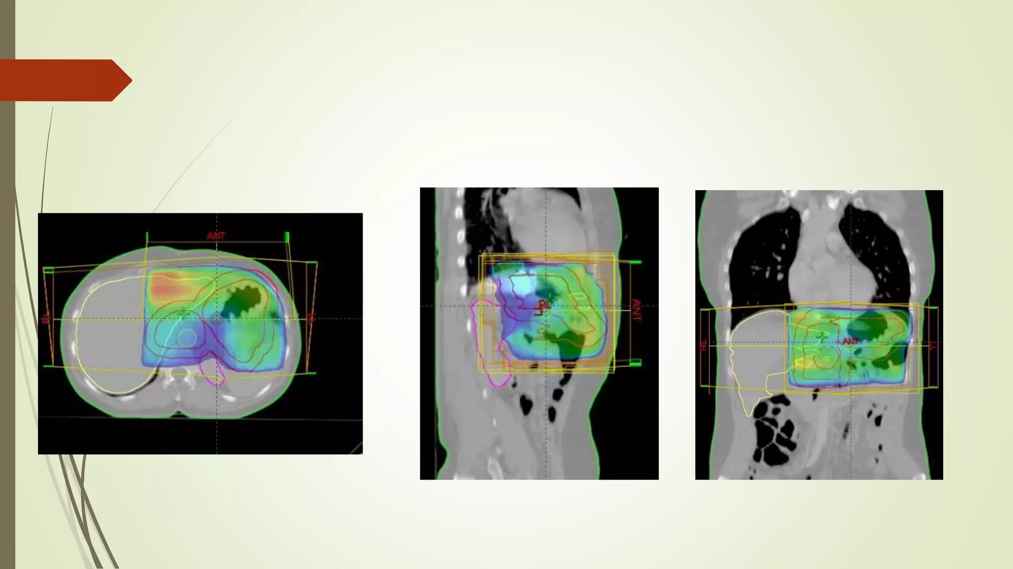 Principles of radiotherapy in gastric carcinoma | PPTX
