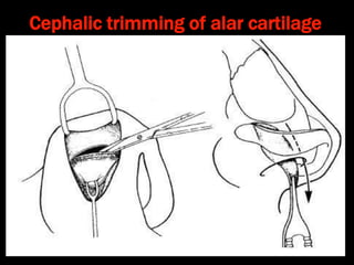 Principles of rhinoplasty | PPT