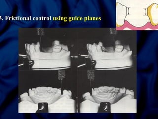 Principles of RPD by Dr. Anand Rajapur | PPT