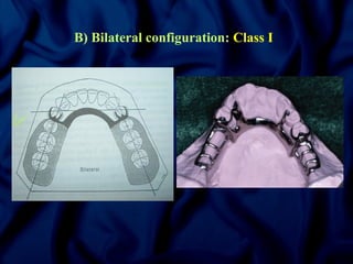 Principles of RPD by Dr. Anand Rajapur | PPT