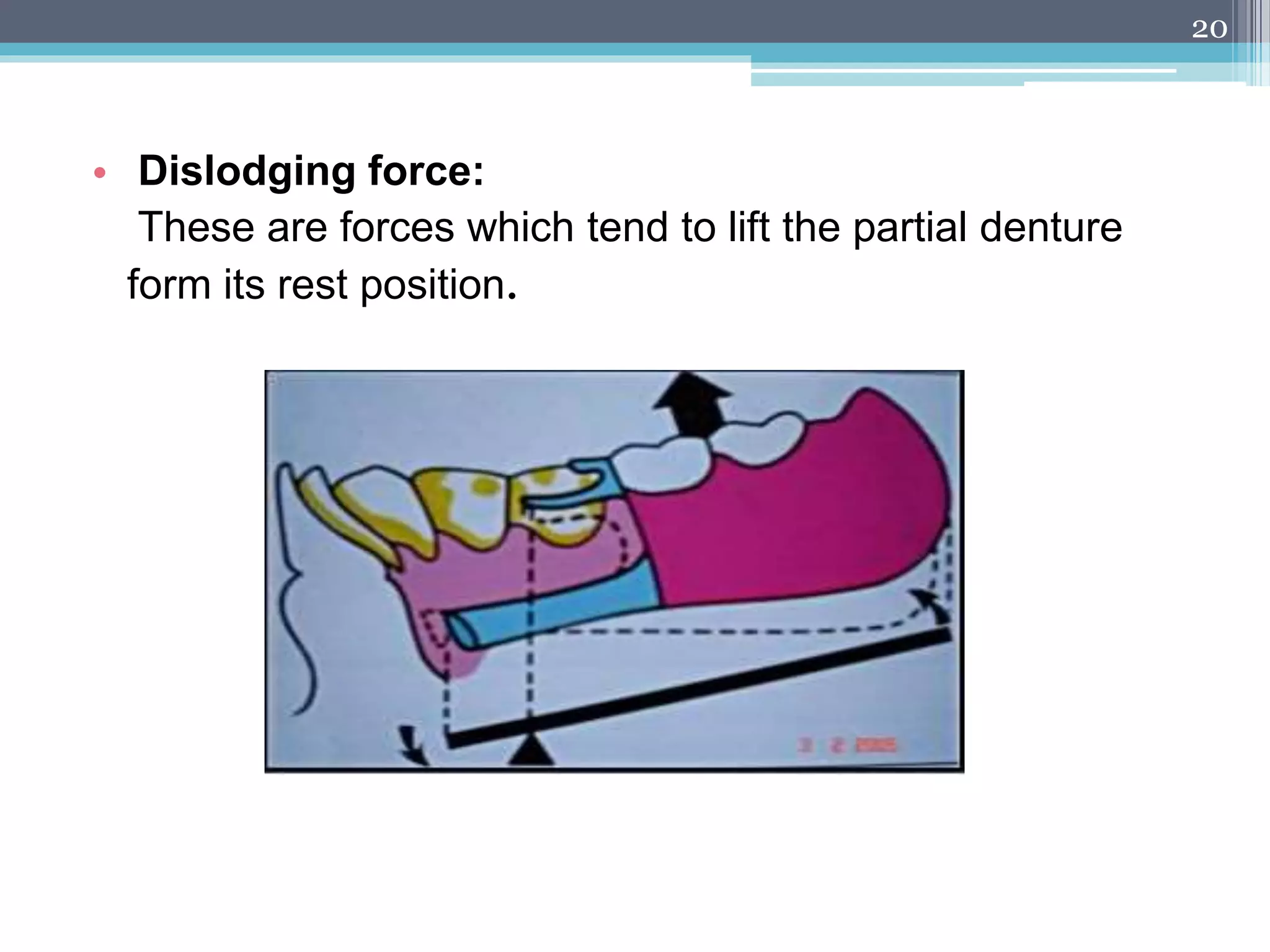 Principles of rpd design according to KENNEDY classification | PPTX