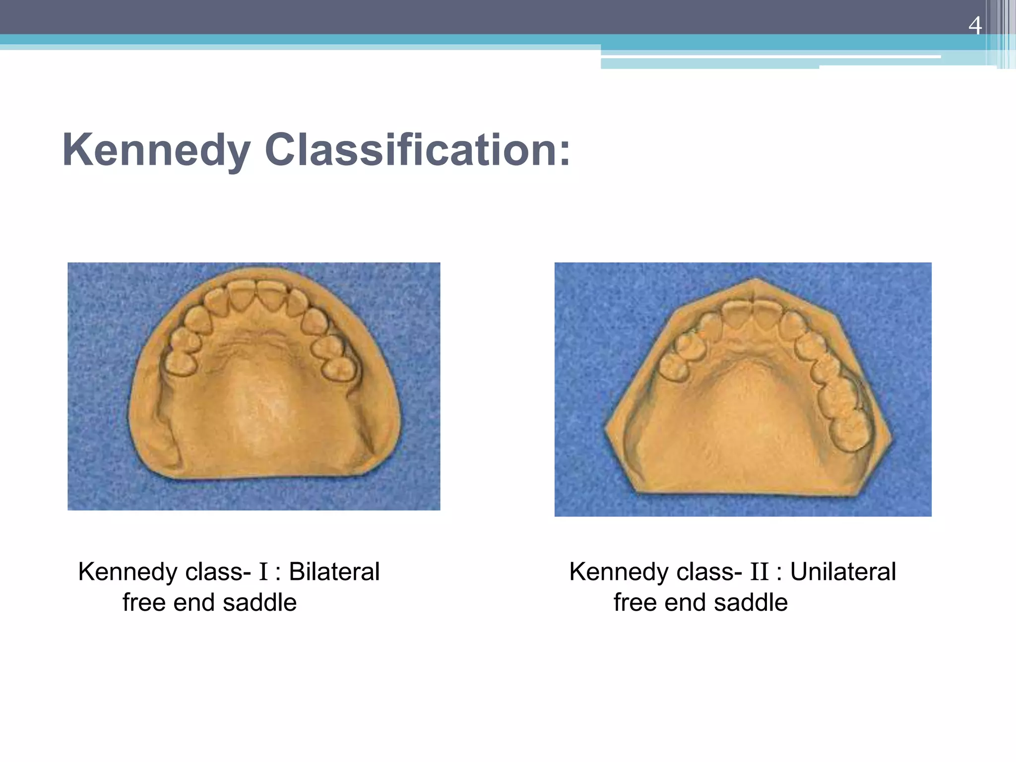 Principles of rpd design according to KENNEDY classification | PPTX