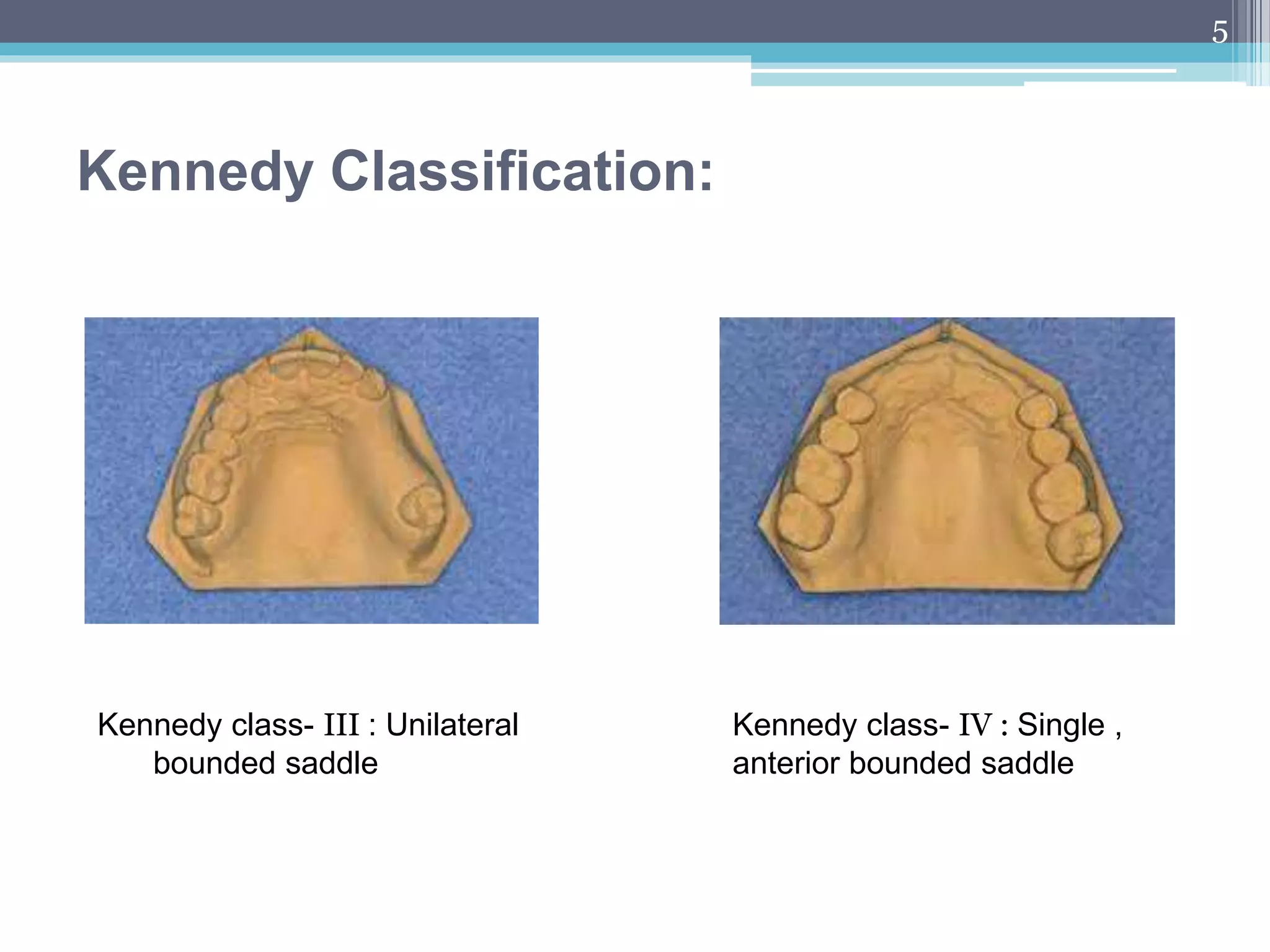 Principles of rpd design according to KENNEDY classification | PPTX