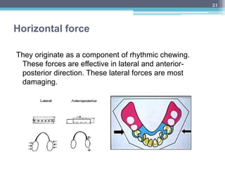 Principles of rpd design according to KENNEDY classification | PPTX