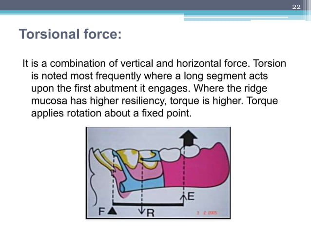 Principles of rpd design according to KENNEDY classification | PPTX