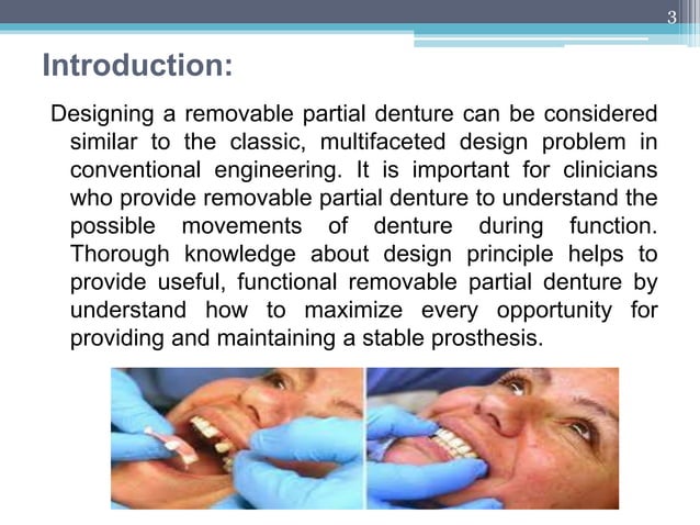 Principles of rpd design according to KENNEDY classification | PPTX