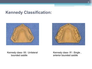 Principles of rpd design according to KENNEDY classification | PPTX