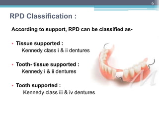 Principles of rpd design according to KENNEDY classification | PPTX