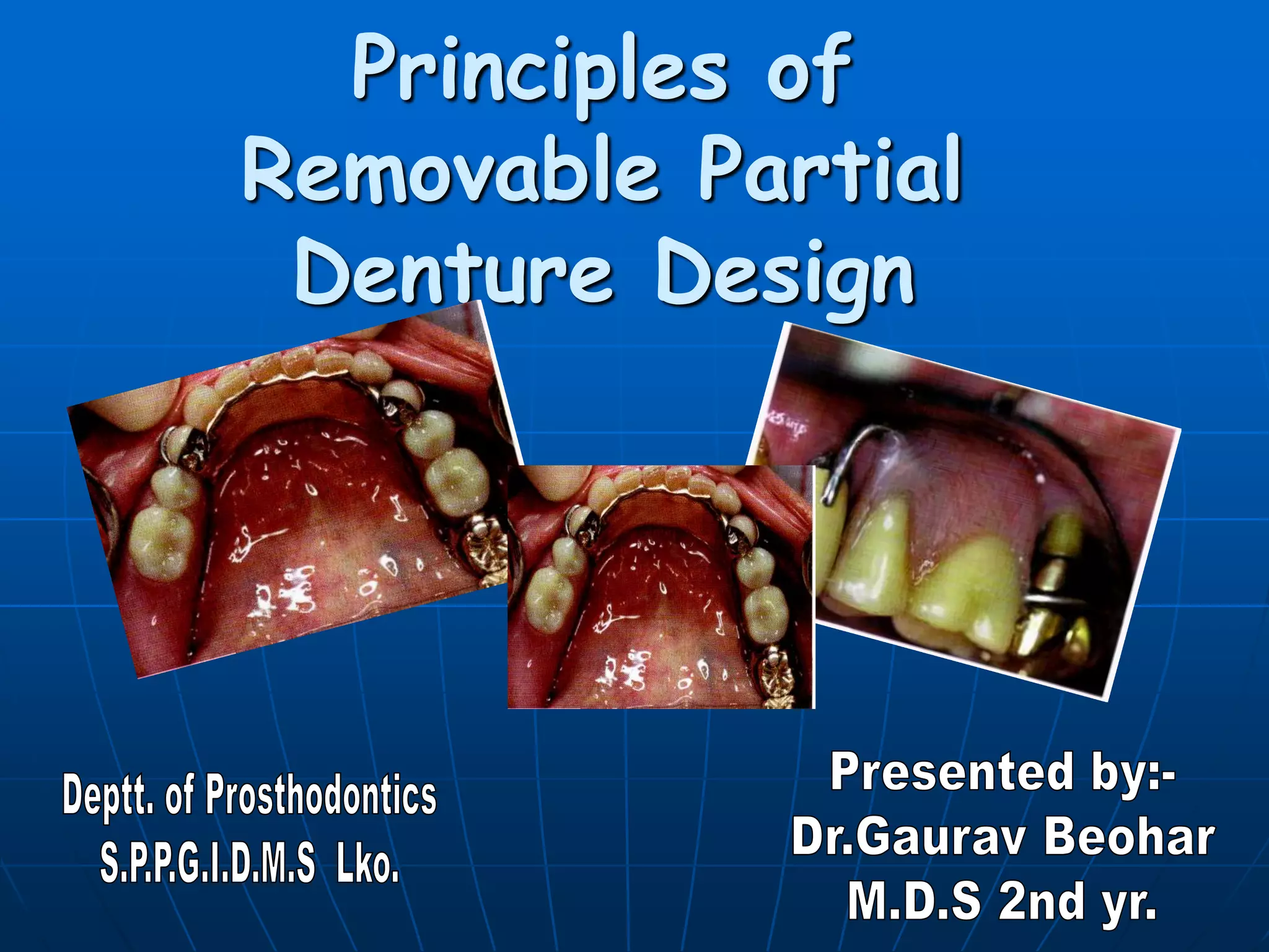 Principles of rpd design | PPT