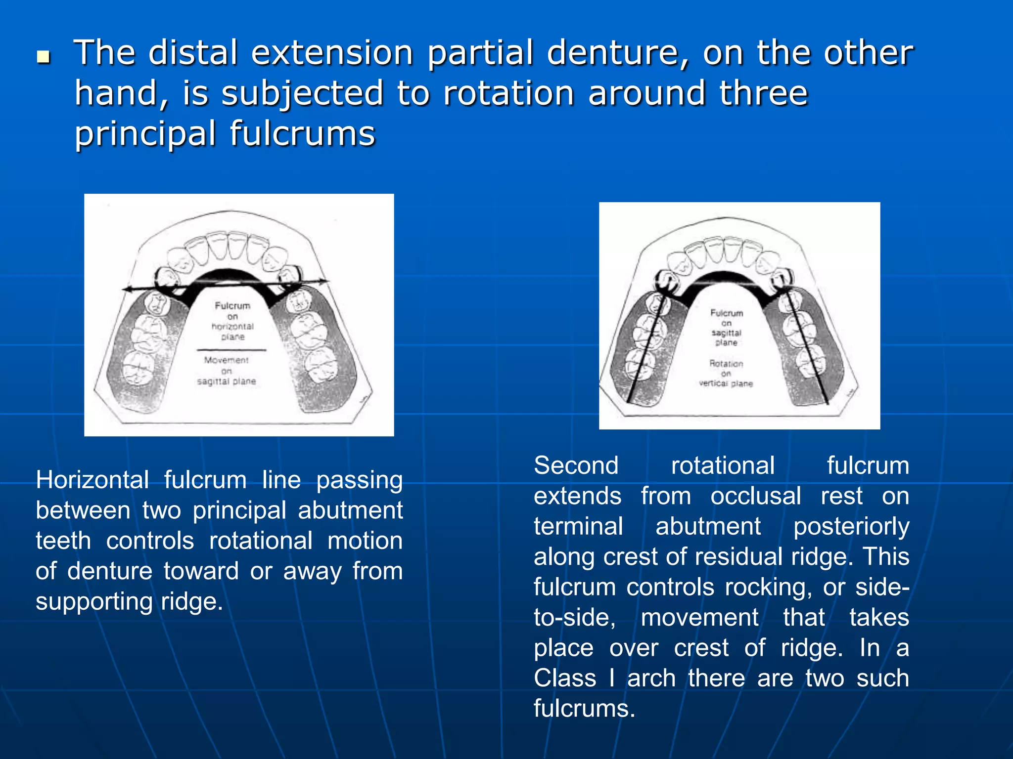 Principles of rpd design | PPT