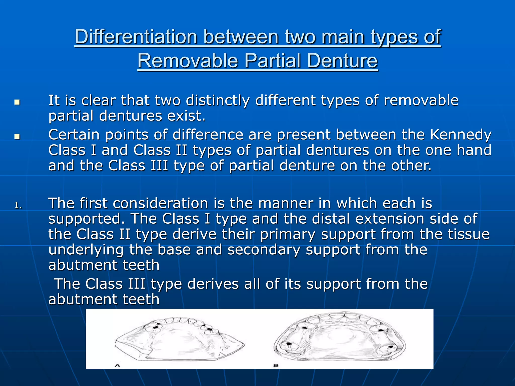 Principles of rpd design | PPT