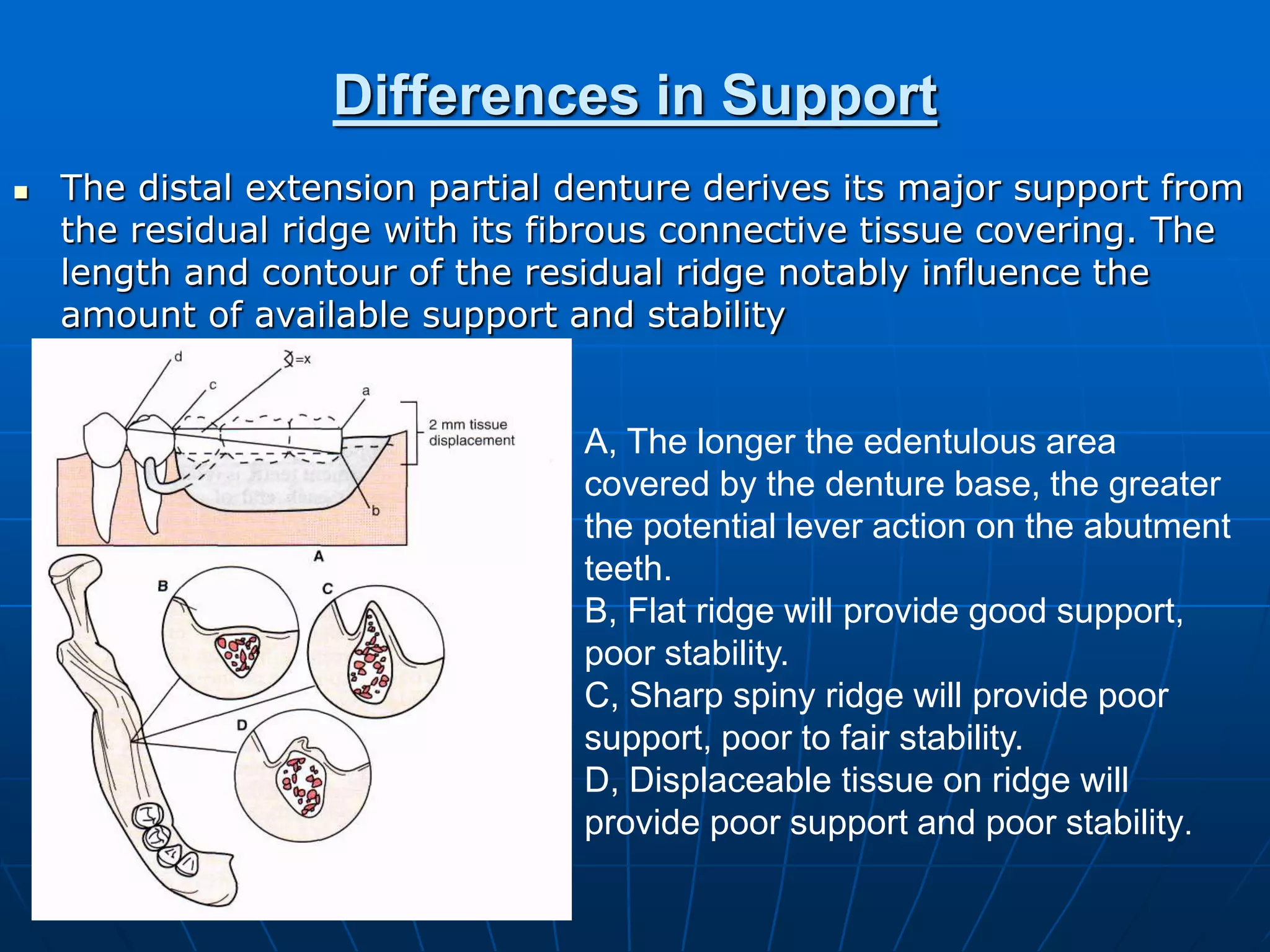 Principles of rpd design | PPT