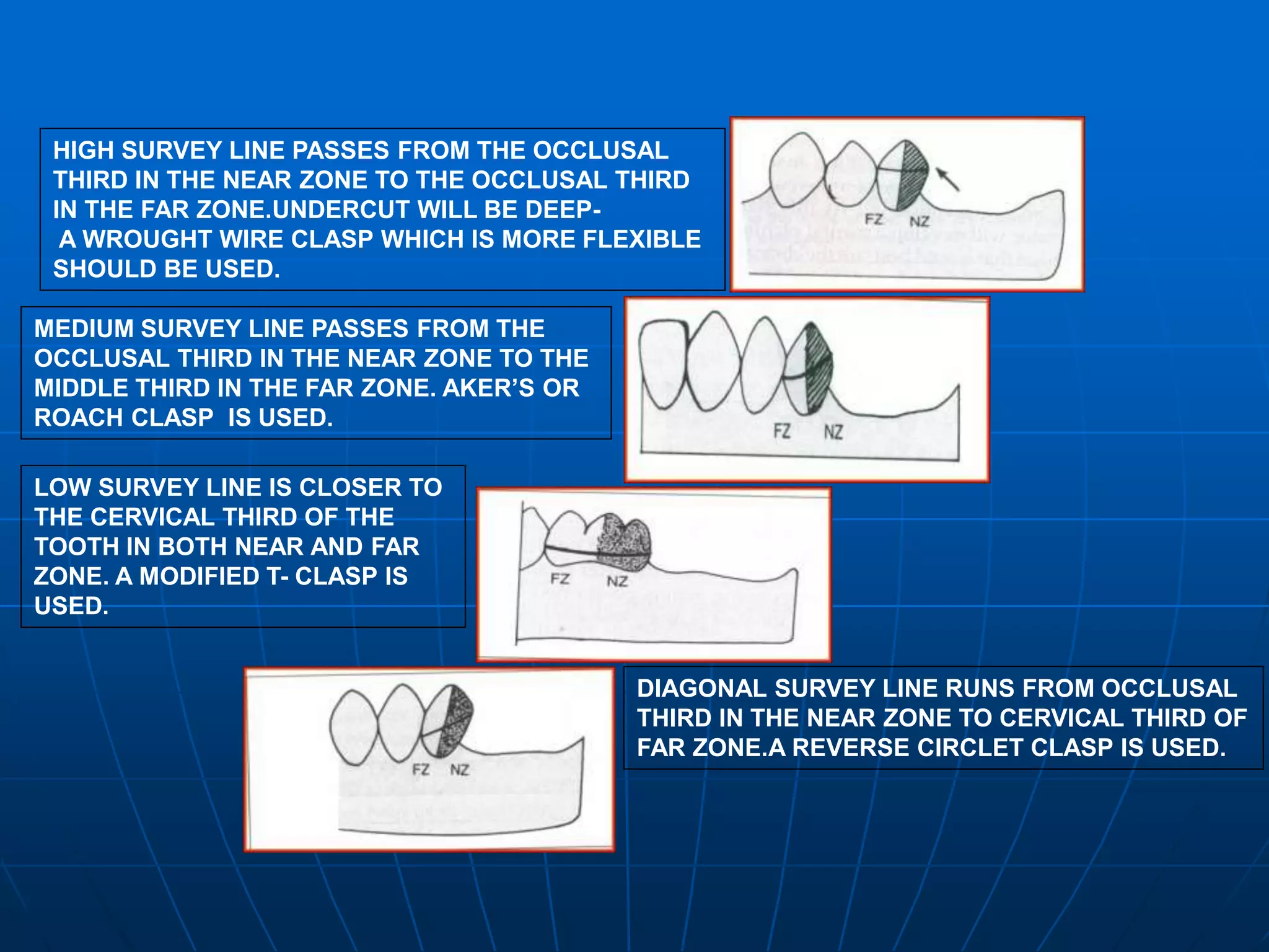 Principles of rpd design | PPT