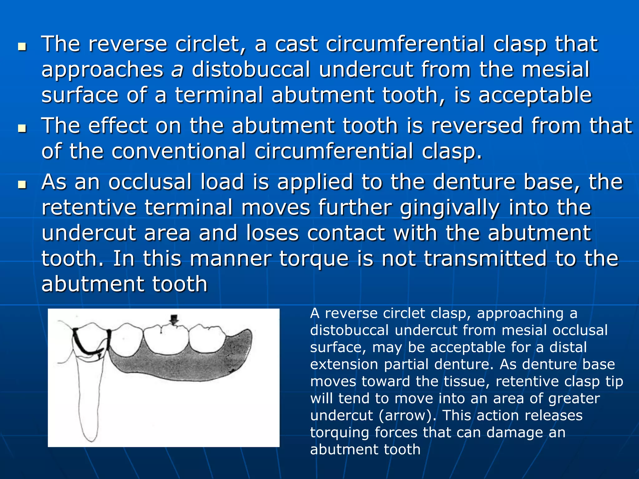 Principles of rpd design | PPT