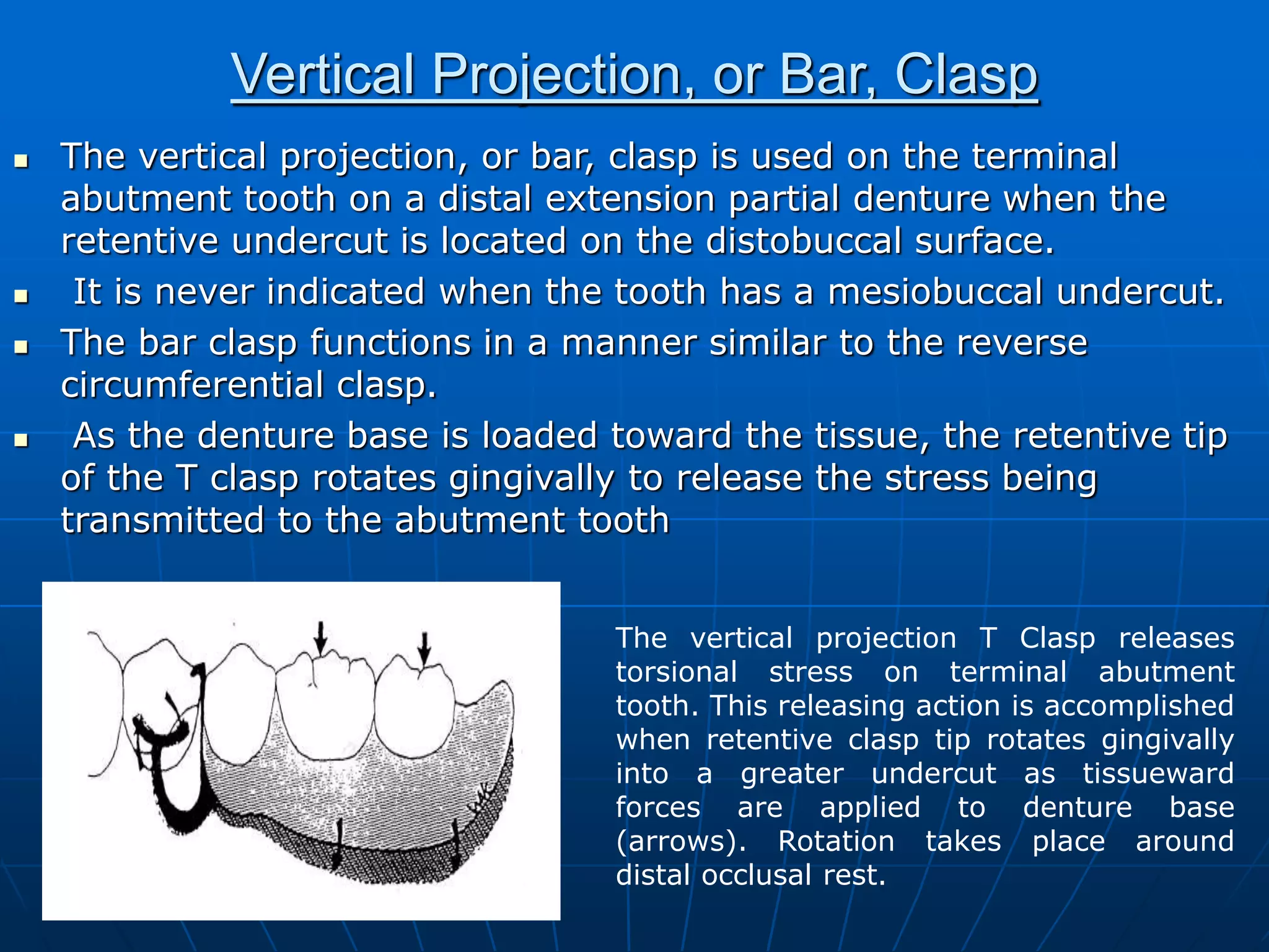 Principles of rpd design | PPT