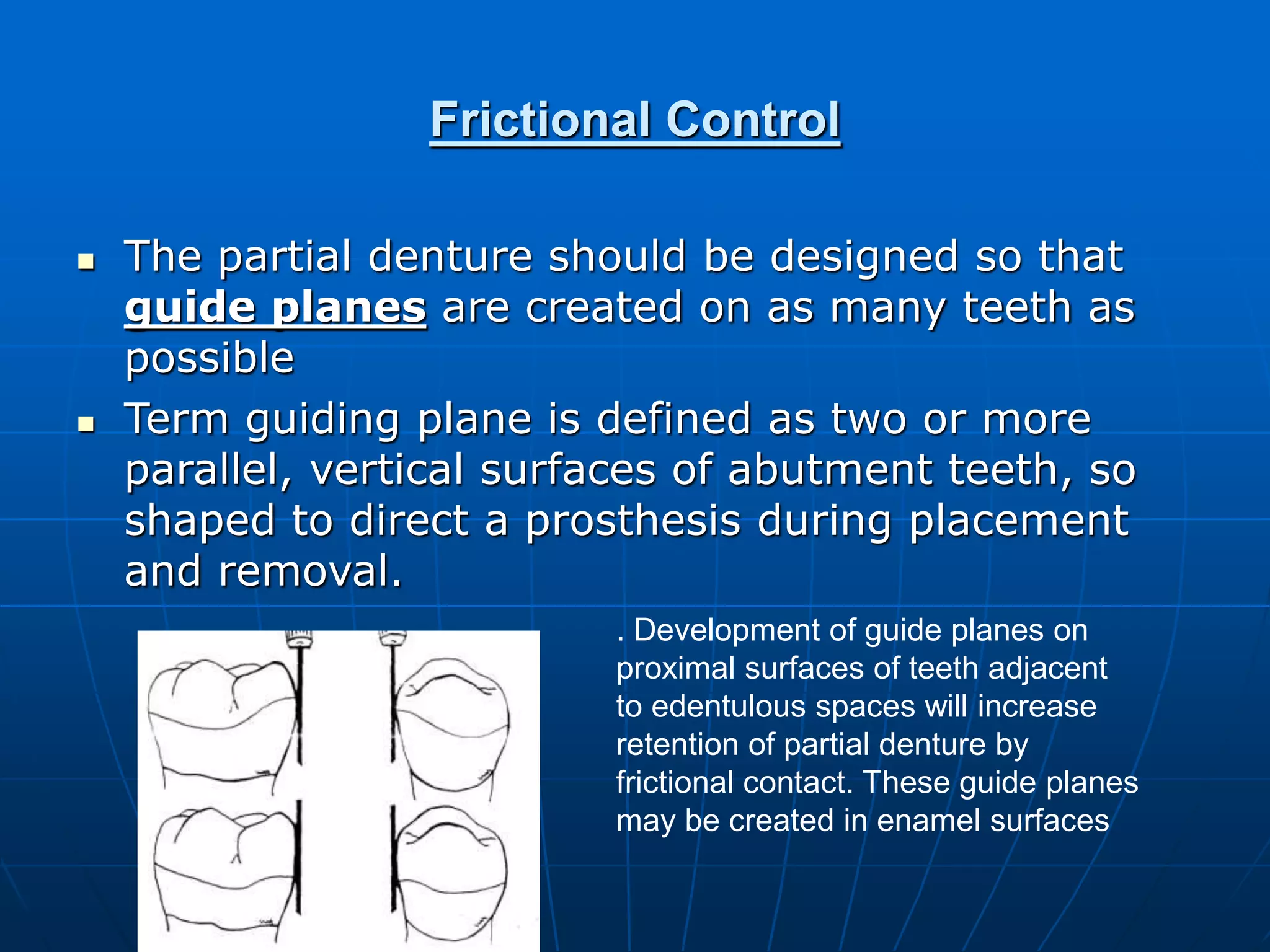 Principles of rpd design | PPT