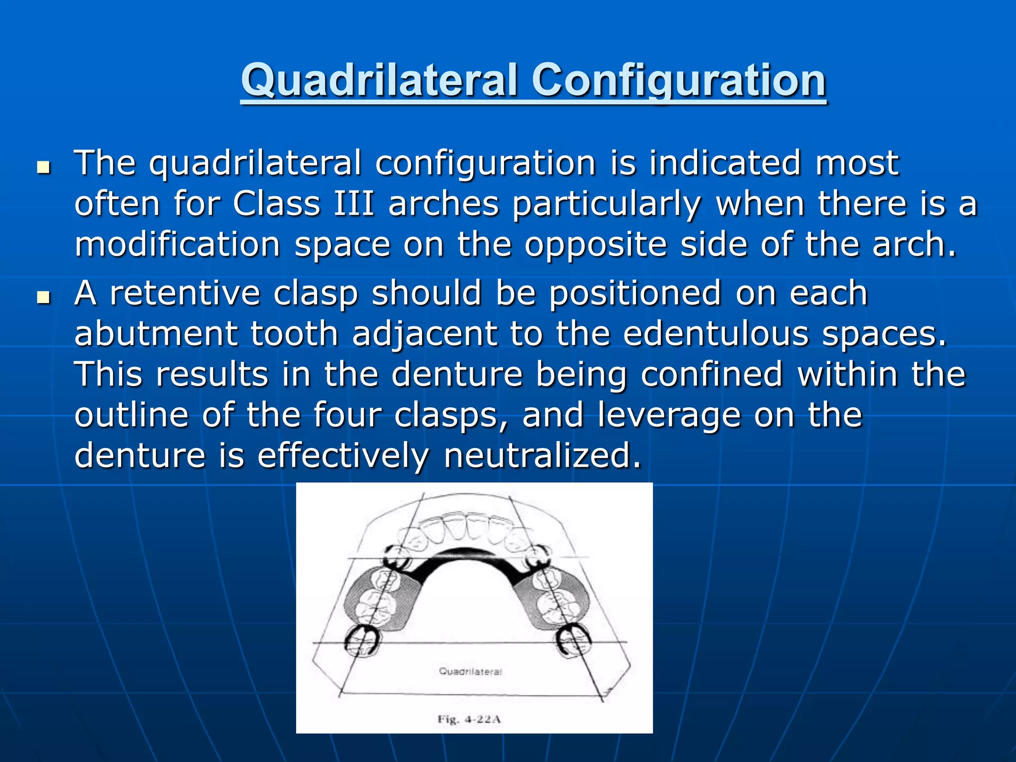 Principles of rpd design | PPT