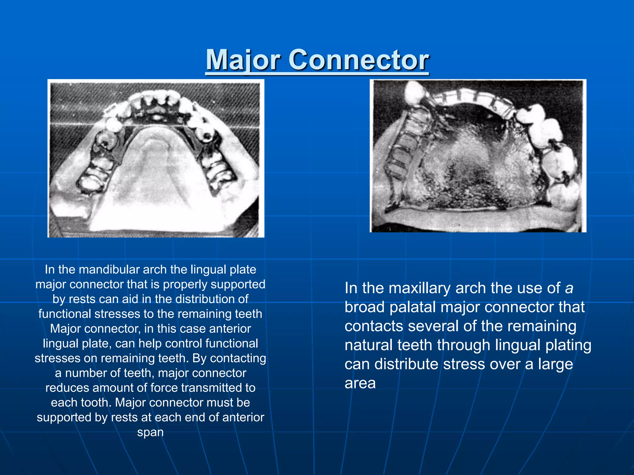Principles of rpd design | PPT