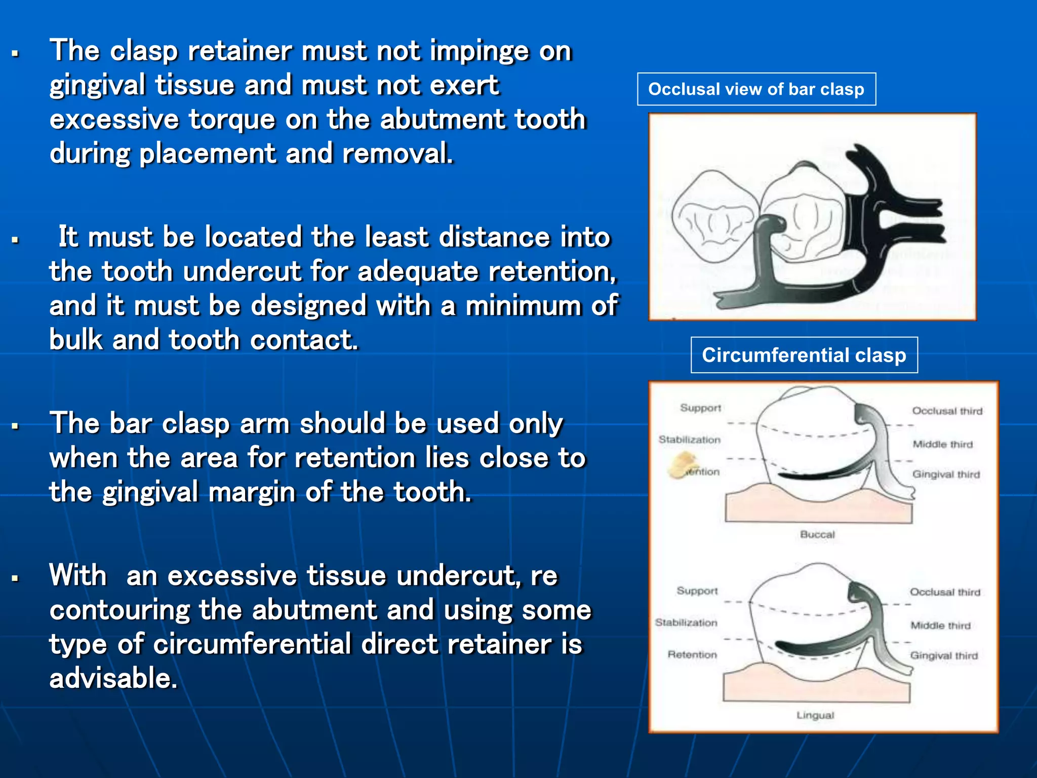 Principles of rpd design | PPT