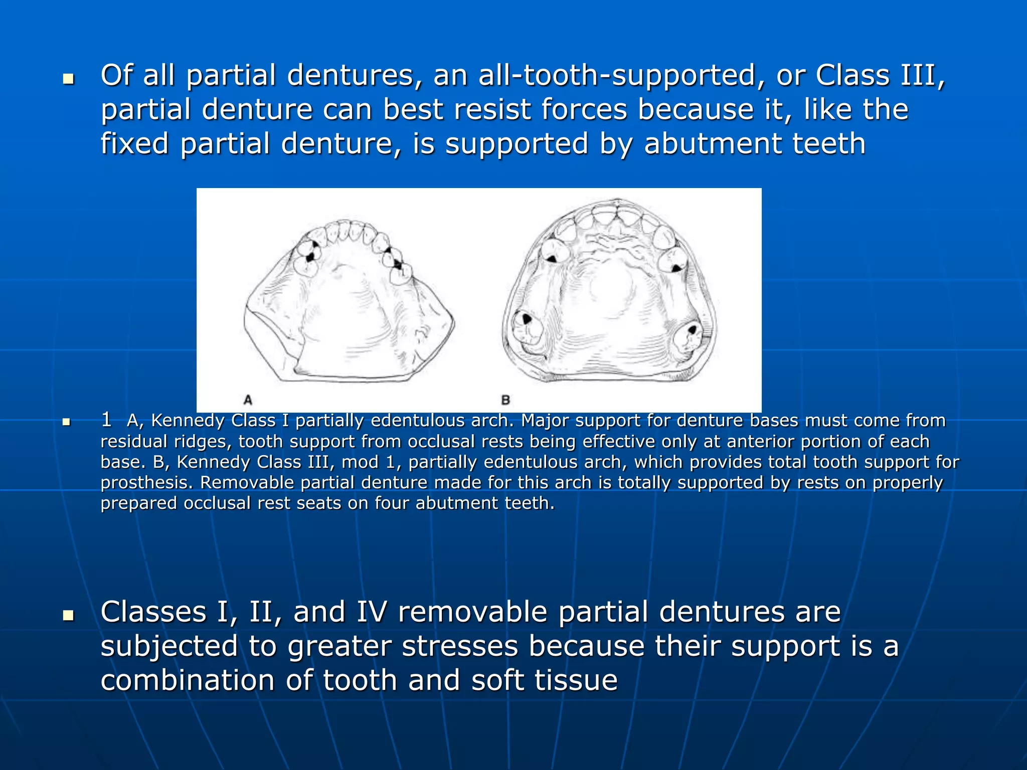 Principles of rpd design | PPT