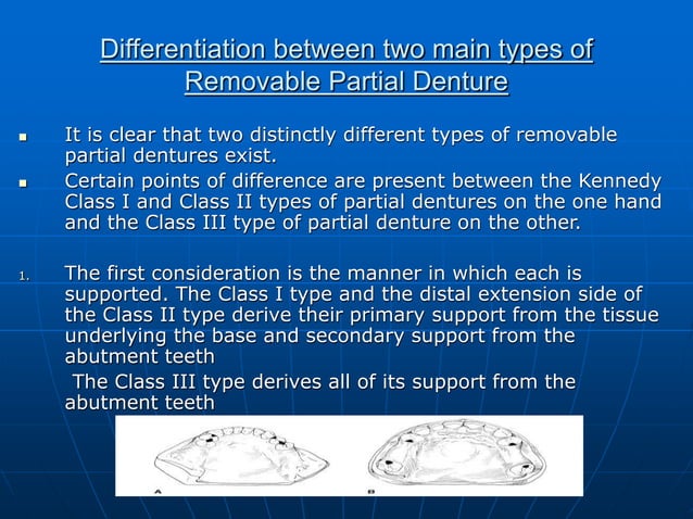 Principles of rpd design | PPT
