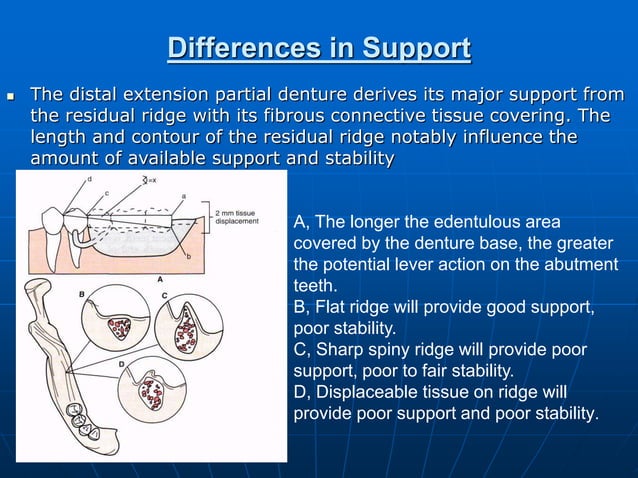 Principles of rpd design | PPT