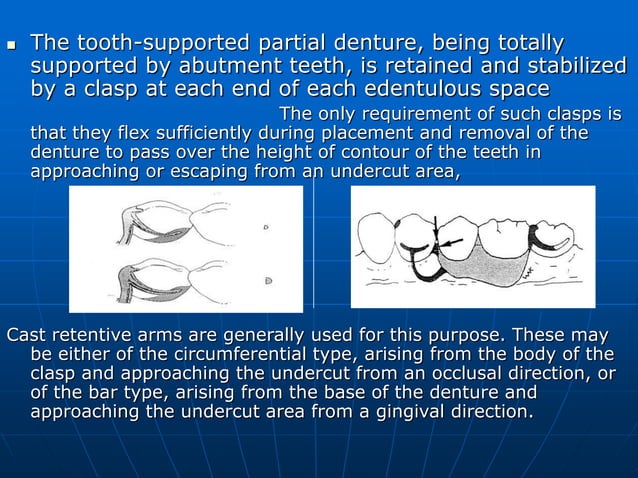 Principles of rpd design | PPT