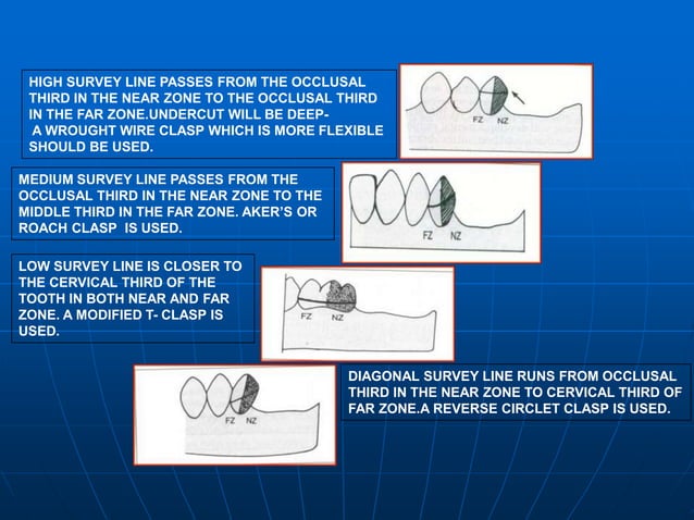 Principles of rpd design | PPT
