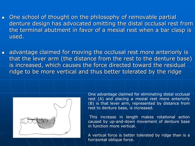 Principles of rpd design | PPT