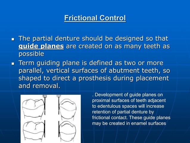 Principles of rpd design | PPT