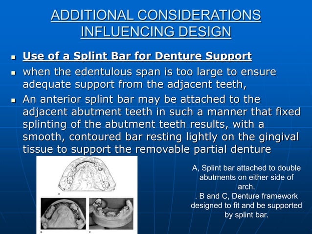 Principles of rpd design | PPT
