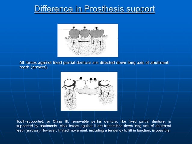 Principles of rpd design | PPT