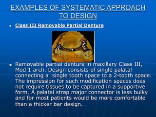 Principles of rpd design | PPT