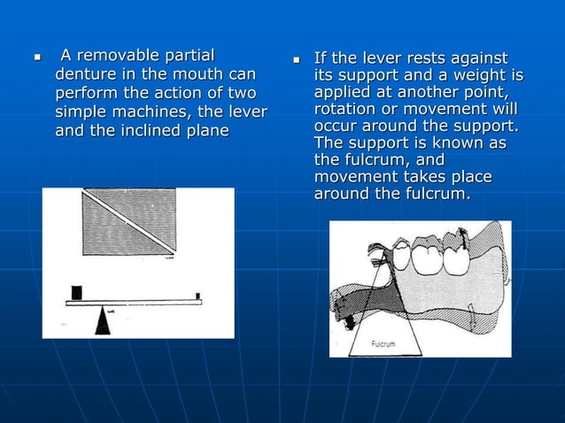 Principles of rpd design | PPT