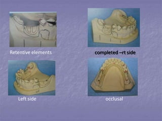 principles of rpd design.ppt
