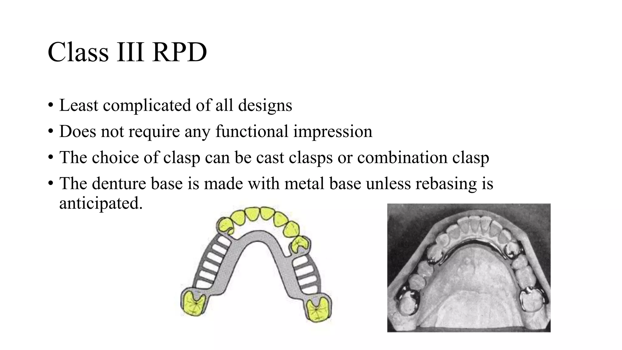 Principles of RPD designing | PPTX