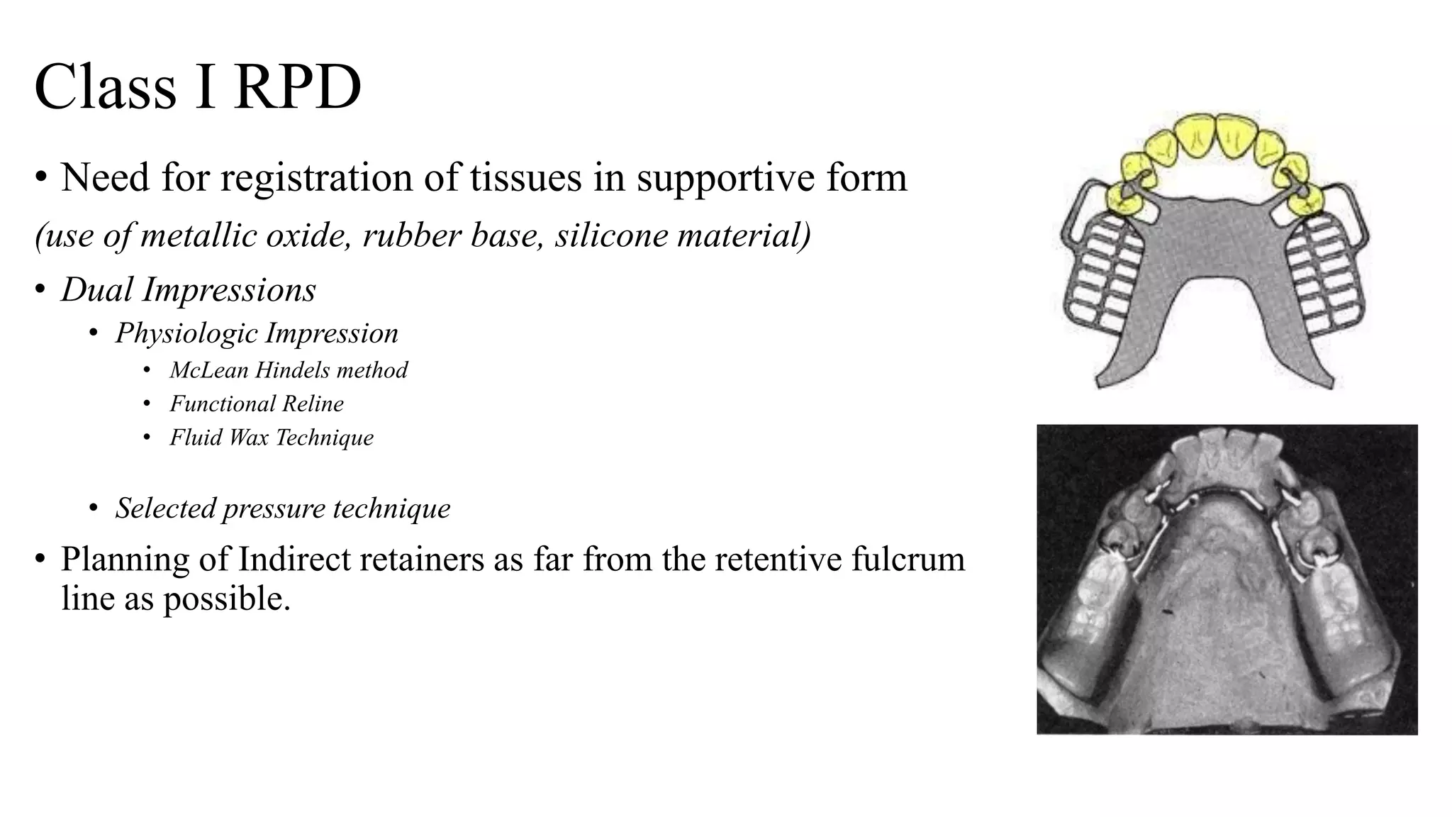 Principles of RPD designing | PPTX