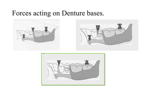 Principles of RPD designing | PPTX | Dental Health | Diseases and ...
