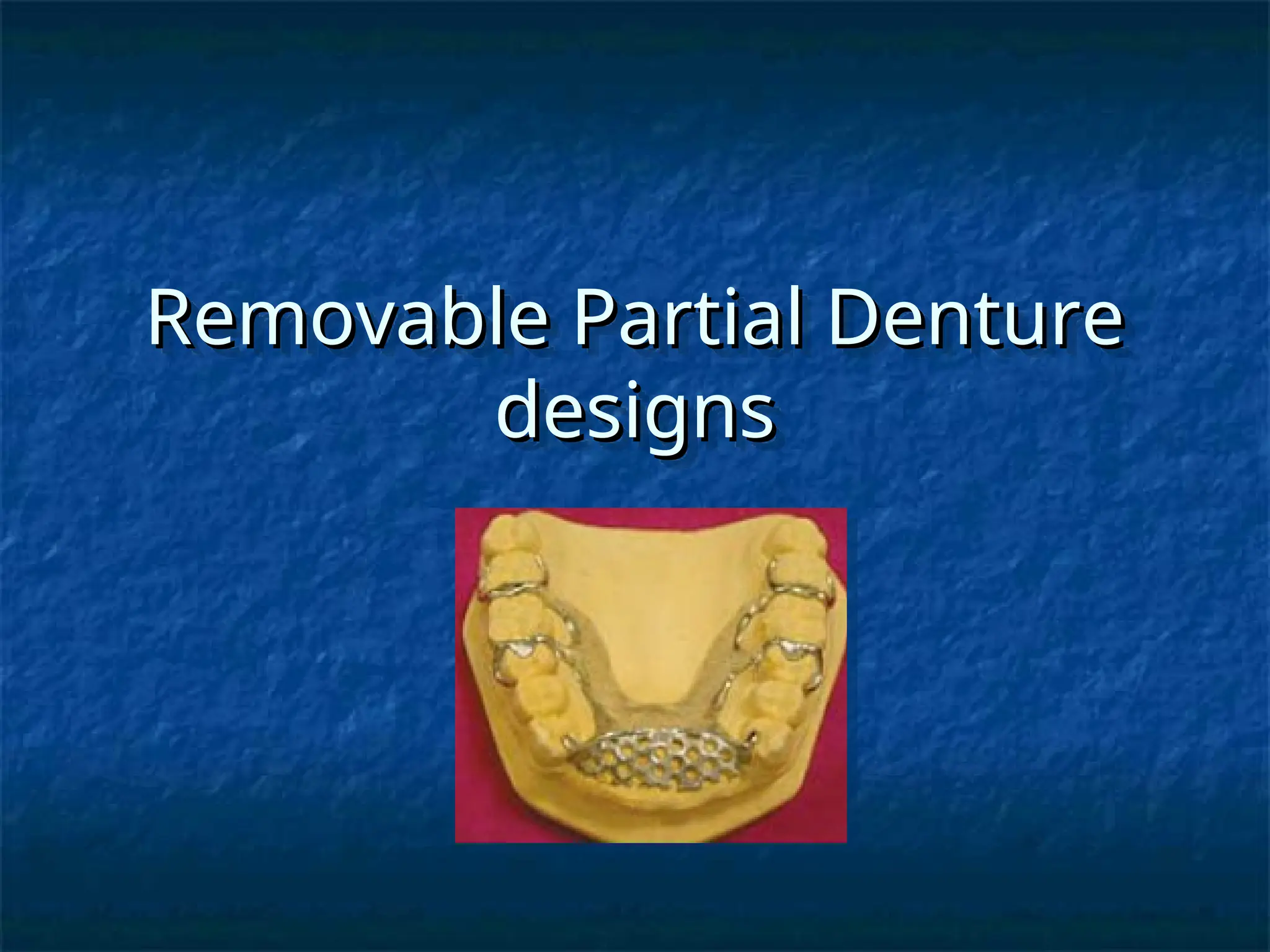 principles of rpd designing.ppt design consideration | PPT