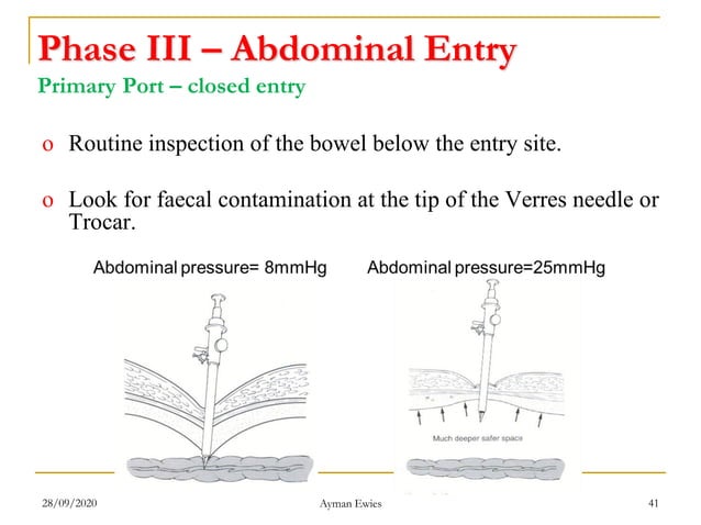 Dr Ayman Ewies - Principles of Safe Laparoscopic Entry | PDF