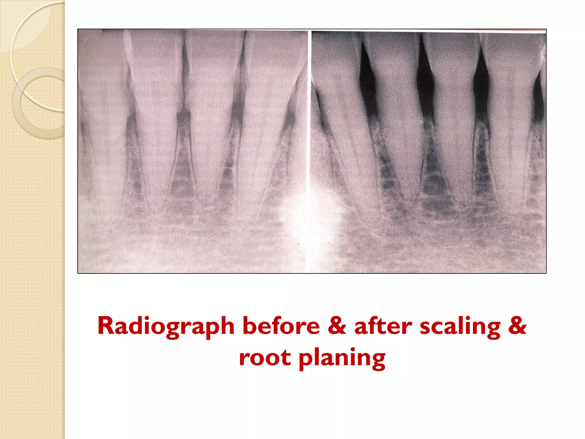 Principles of scaling & root planing dr alaa attia | PDF