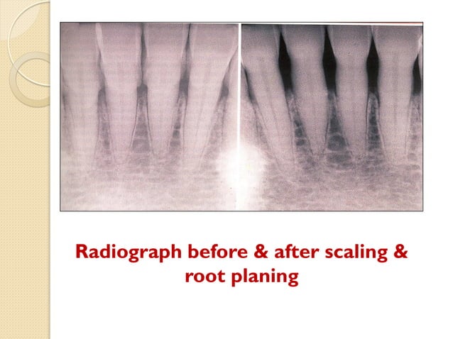 Principles of scaling & root planing dr alaa attia Principles of scaling & root planing dr alaa attia